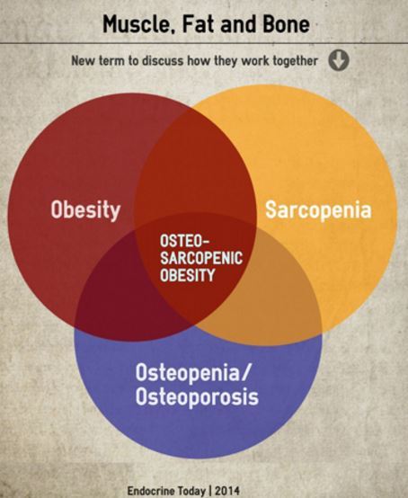Nutritional Approaches for Osteosarcopenic Obesity: Interrelationships between Bone, Muscle and ...